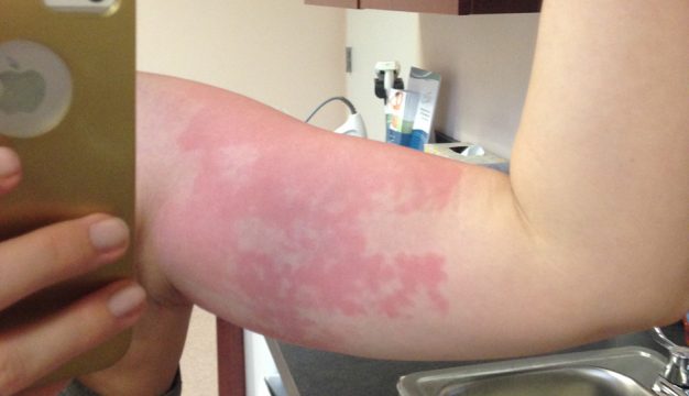 We Tried It: Can a Fat Laser Actually Get Rid of Flabby Arms ...