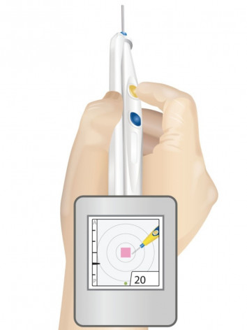 How the SmartClip Soft Tissue Marker Is Advancing Breast Surgery