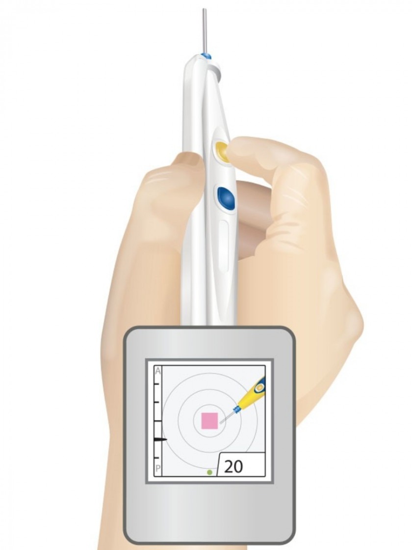 How the SmartClip Soft Tissue Marker Is Advancing Breast Surgery